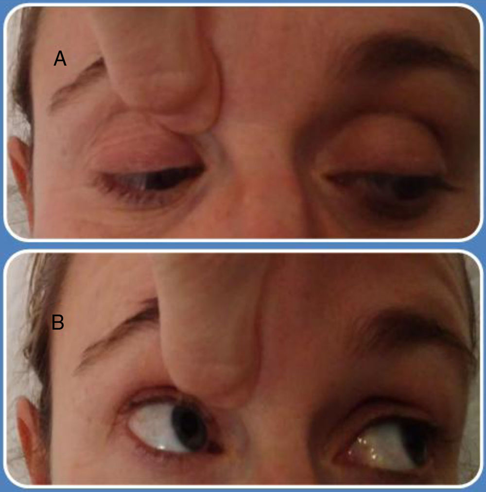 Primary trochlear headache. A periorbital pain with a specific ...