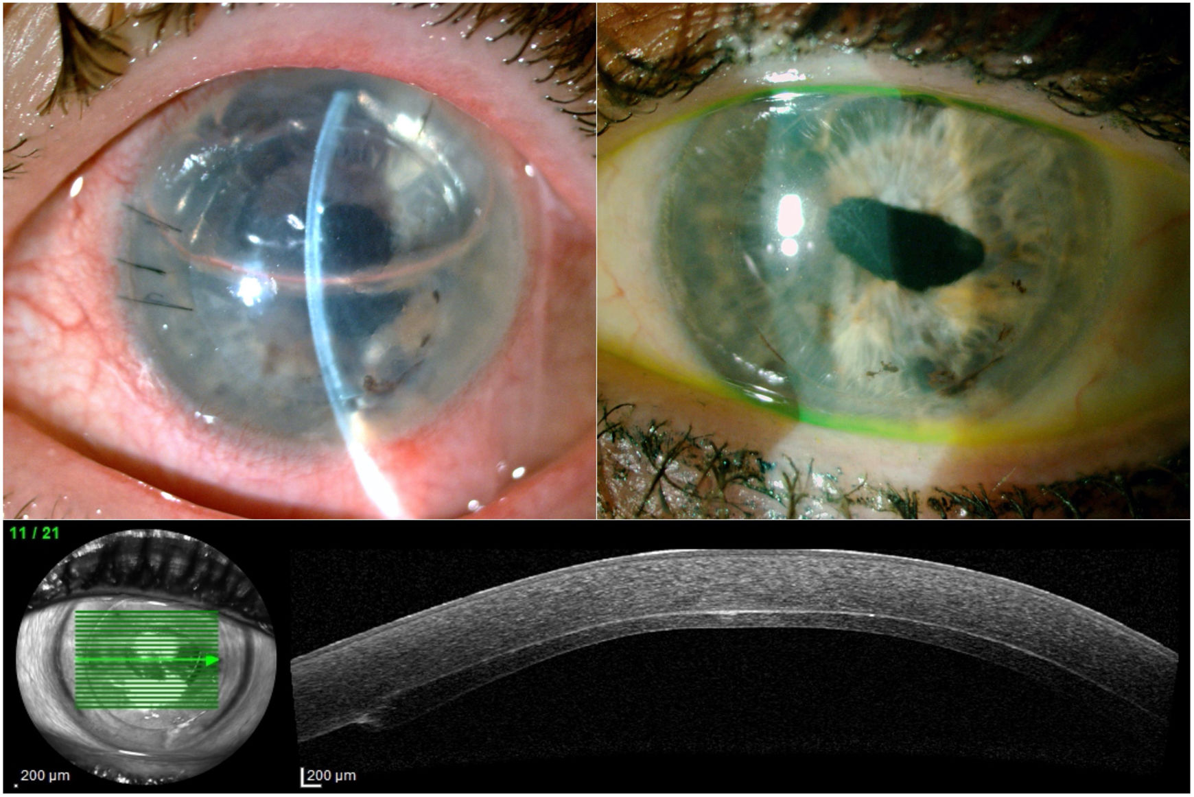 Combined cataract surgery and lamellar endothelial keratoplasty in ...