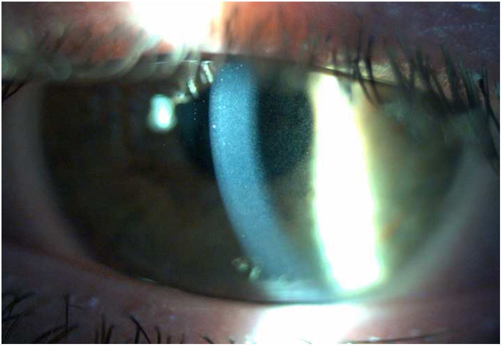 Ocular surface analysis in patients diagnosed with X-linked ichthyosis ...