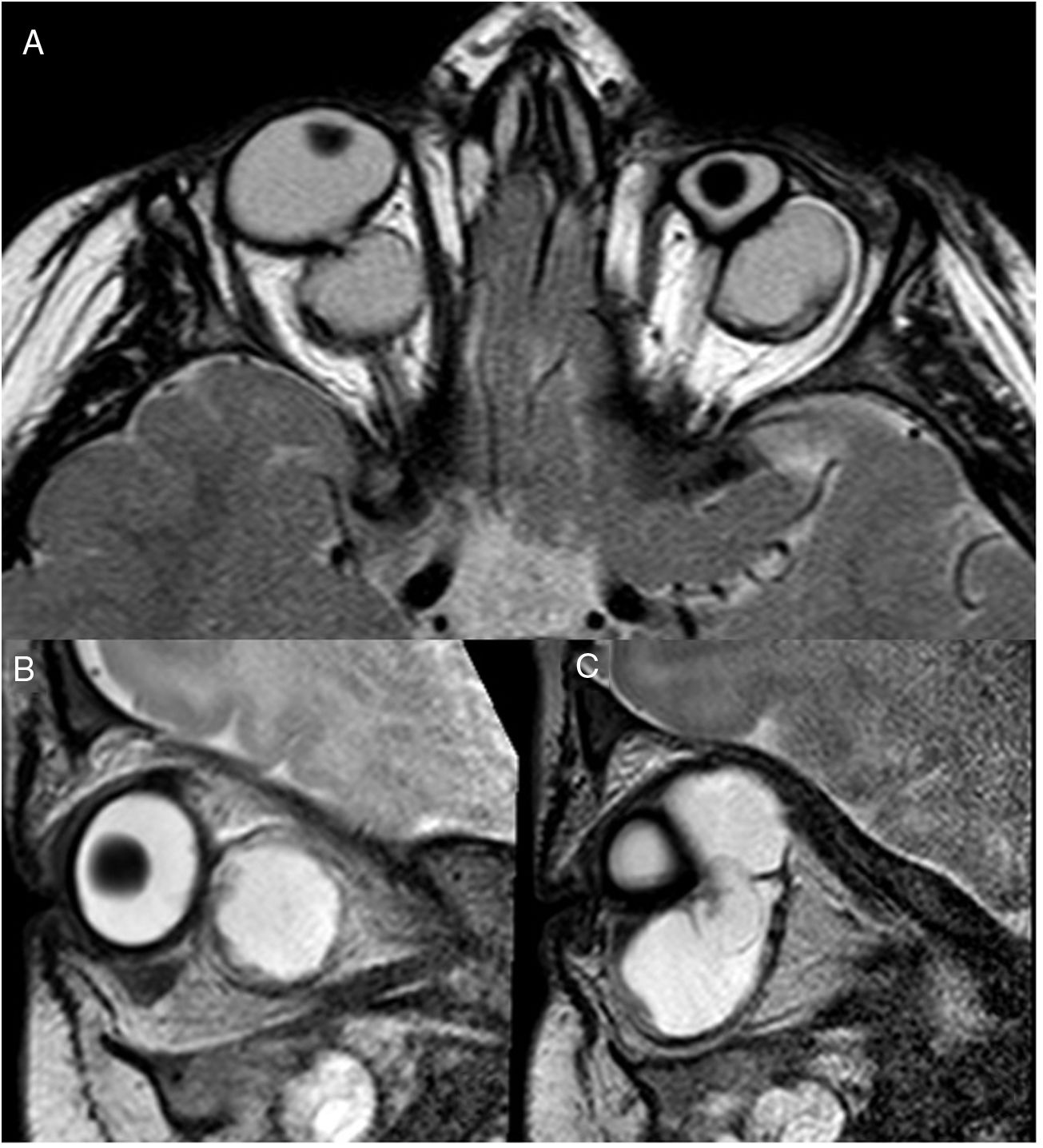 Bilateral microphthalmos with bilateral orbital cysts: individualising ...