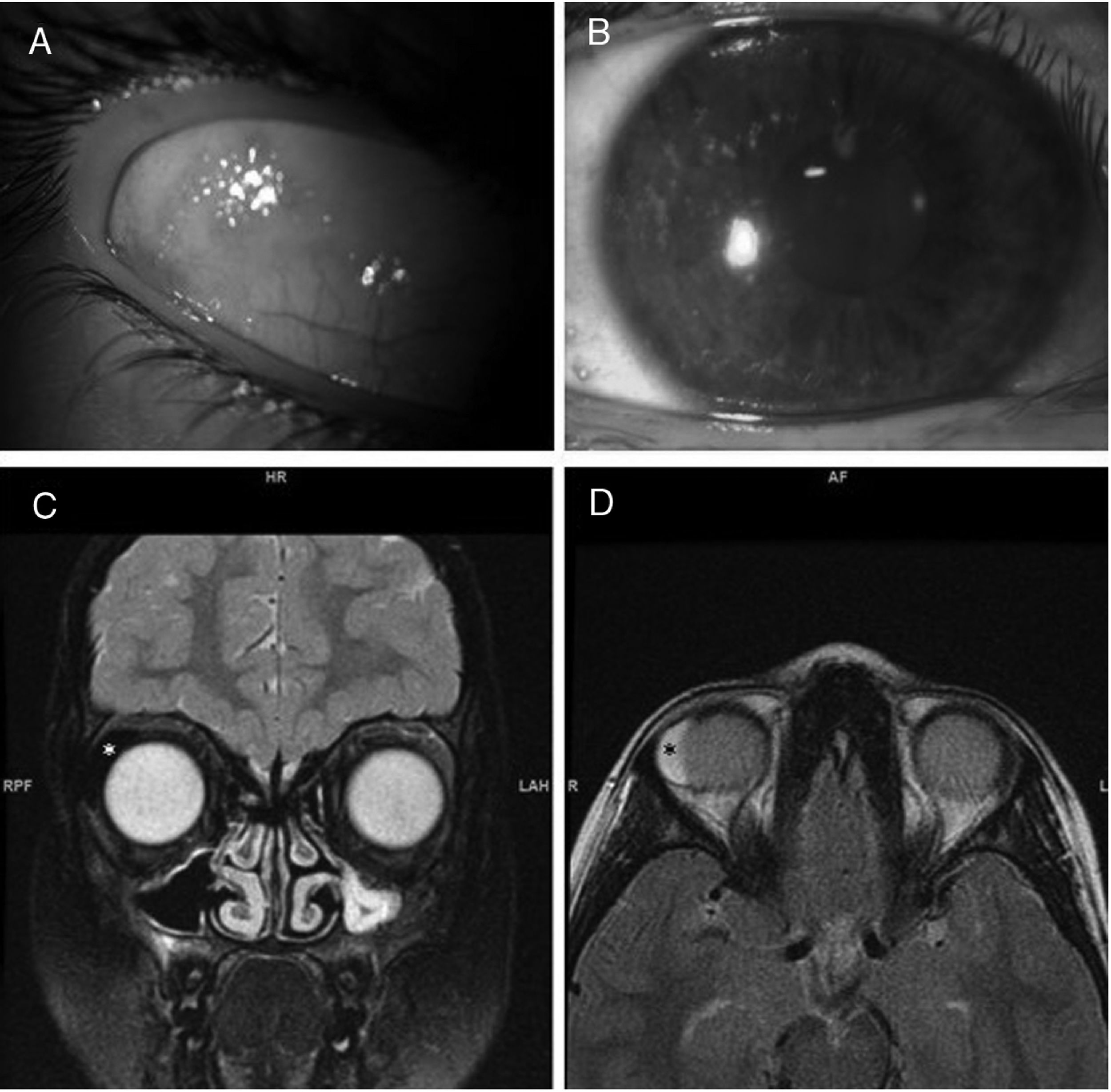 Congenital unilateral absence of the lacrimal gland combined with ...