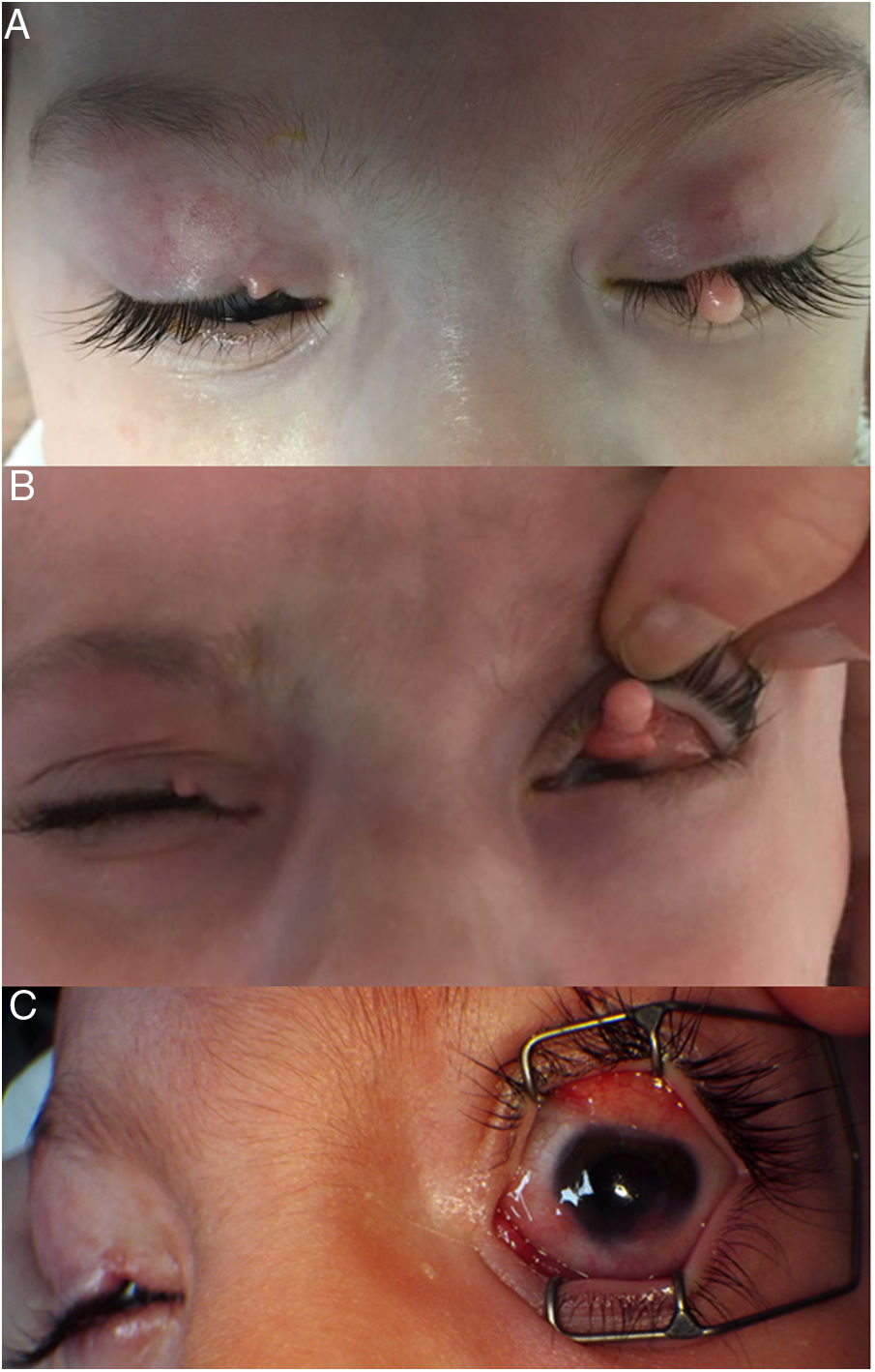 Haberland syndrome with bilateral ocular involvement | Archivos de la ...