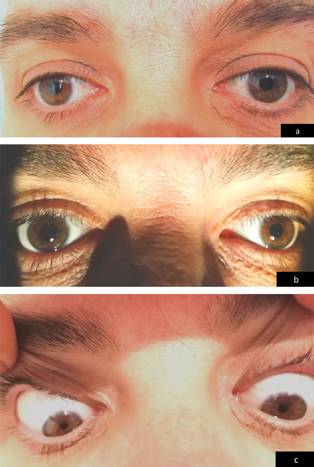 Holmes-Adie syndrome as an early manifestation of systemic lupus ...