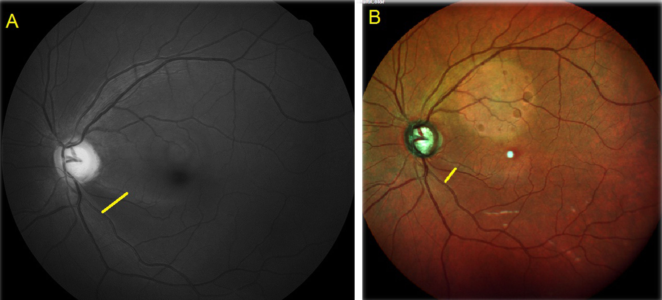 Use of the new MultiColour SPECTRALIS® software for identifying retinal ...