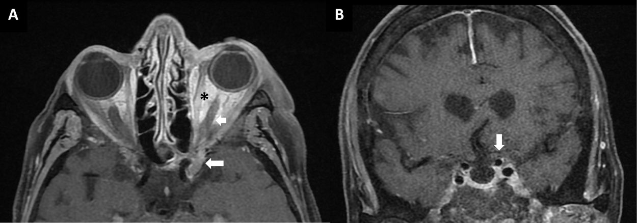 Orbital apex syndrome secondary to herpes zoster ophthalmicus ...