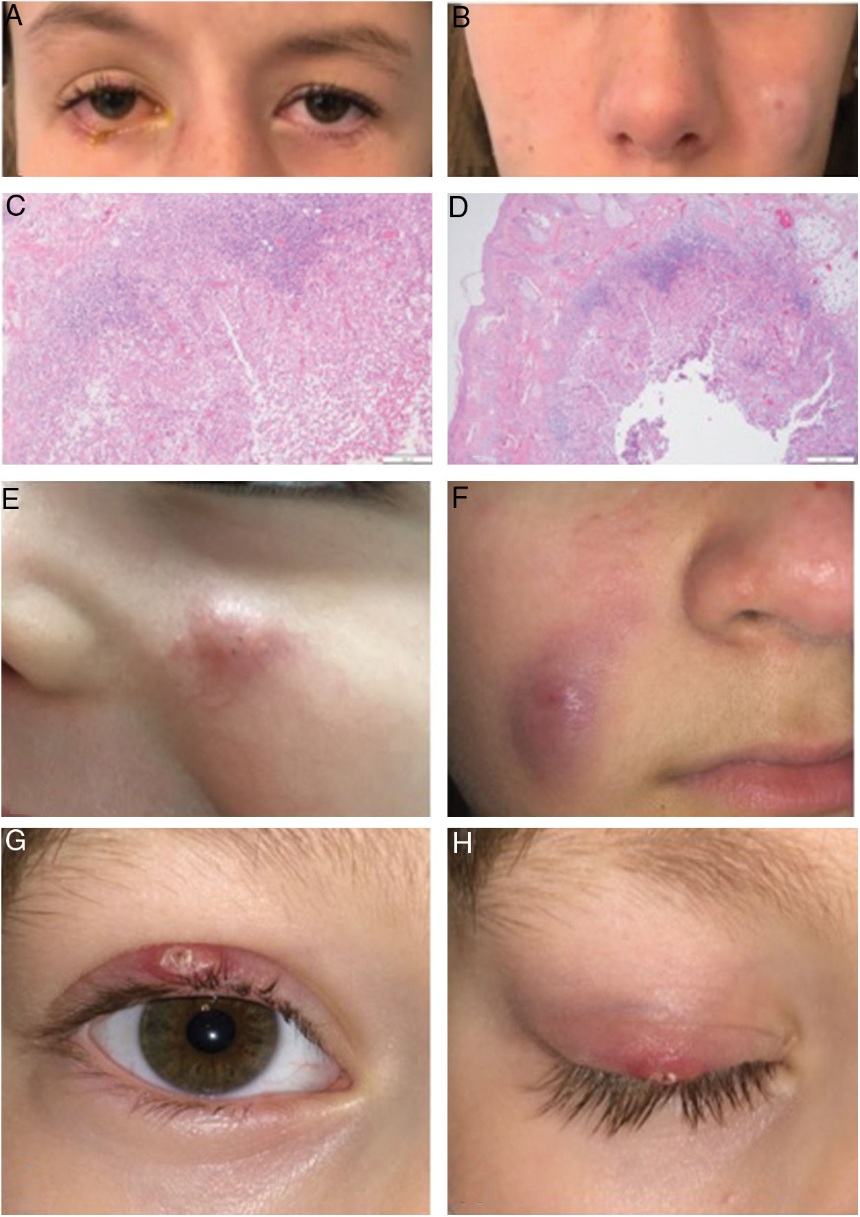 Eyelid nodules in idiopathic facial aseptic granuloma | Archivos de la ...