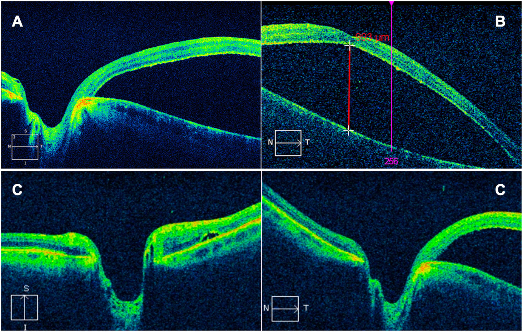 Combined treatment for optic disc pit maculopathy secondary to glaucoma ...