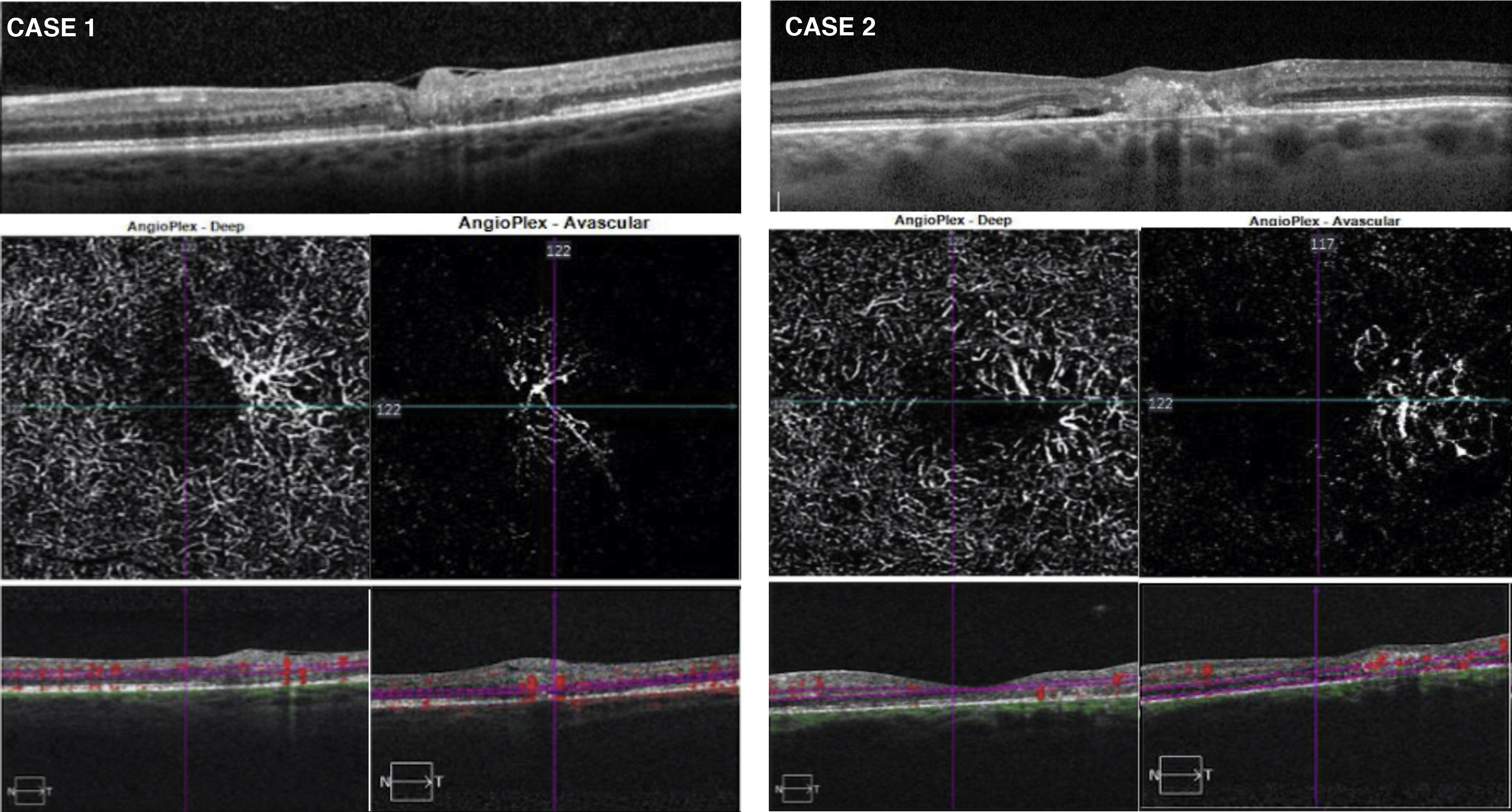 OCT-angiography for diagnosis and response to treatment of subretinal ...