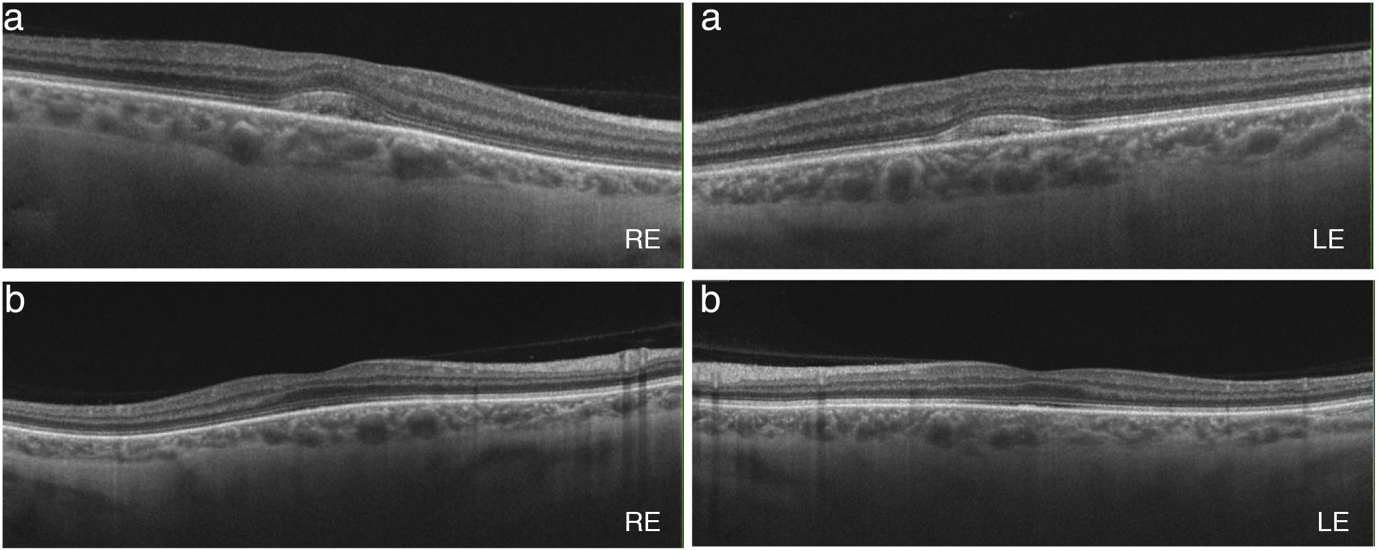 Mitogen-activated protein kinase inhibitor-associated retinopathy ...