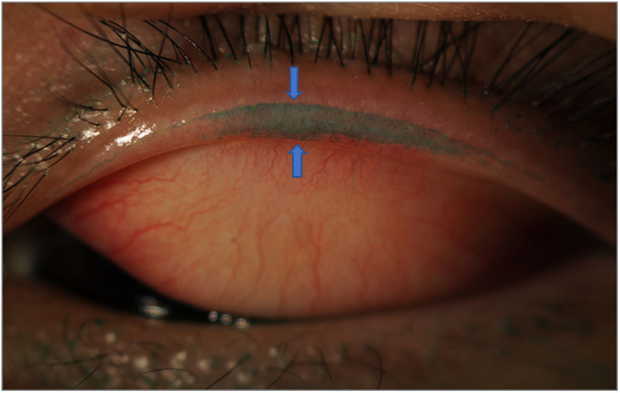 Lid wiper epitheliopathy in patients with blepharospasm and/or ...