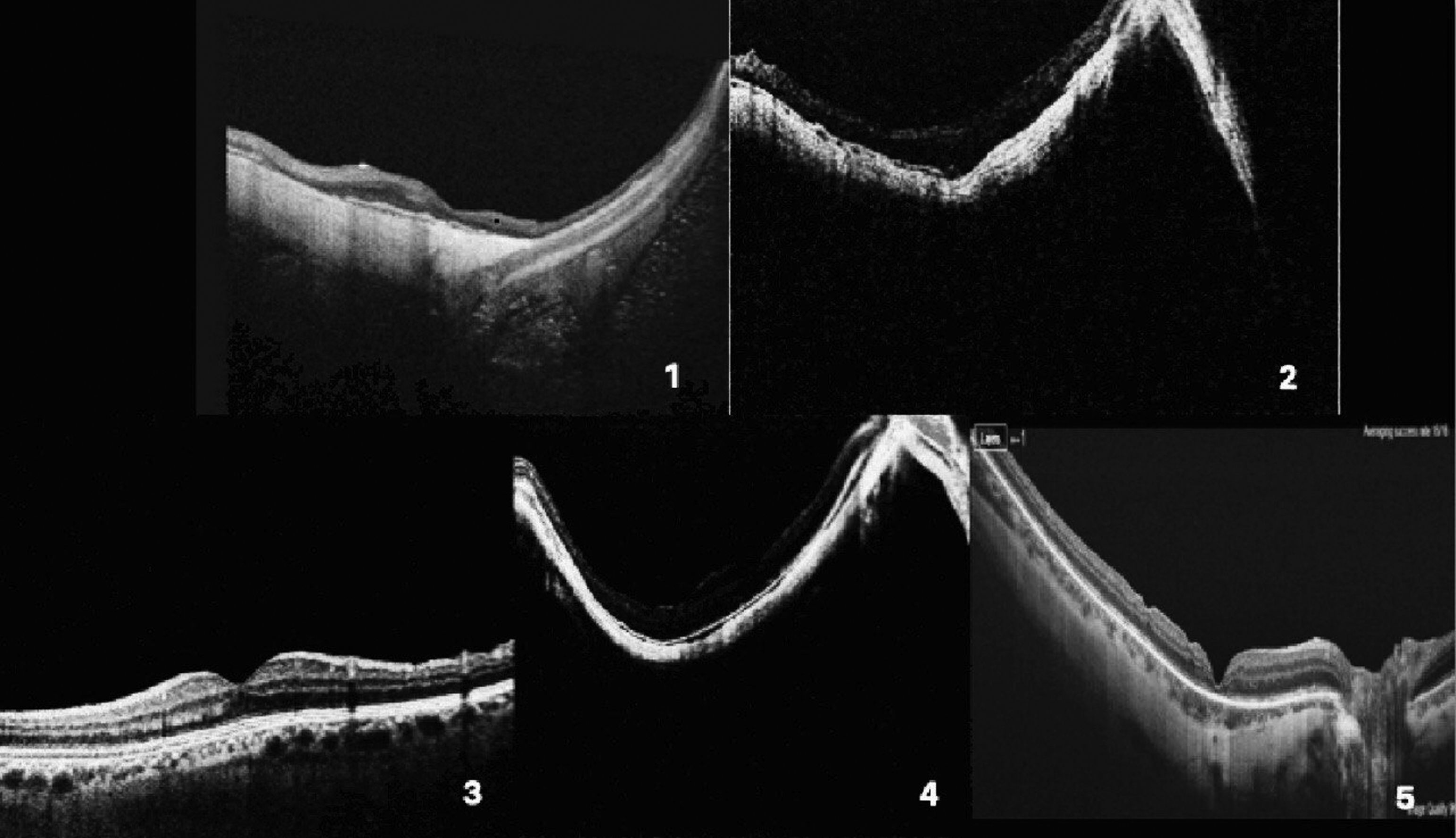 Modified superior inverted internal limiting membrane flap technique ...