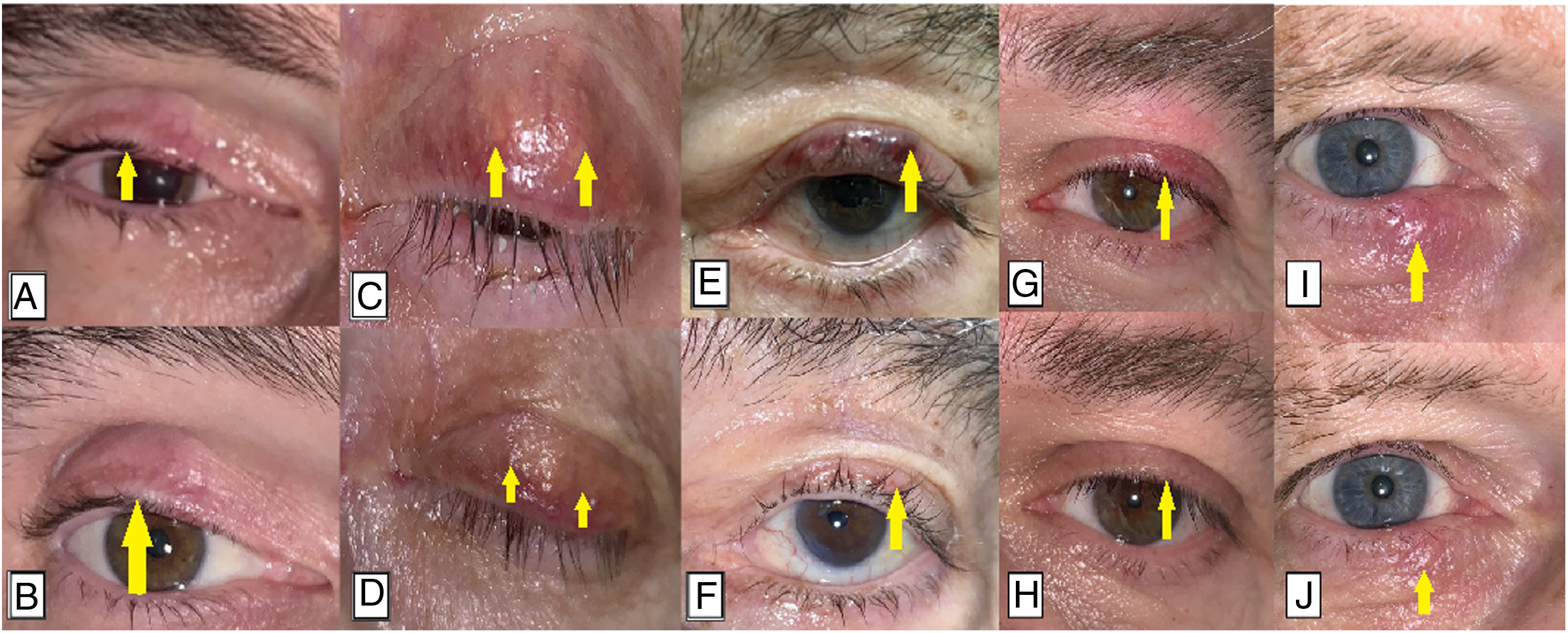 Intense pulsed light combined with meibomian gland expression for ...