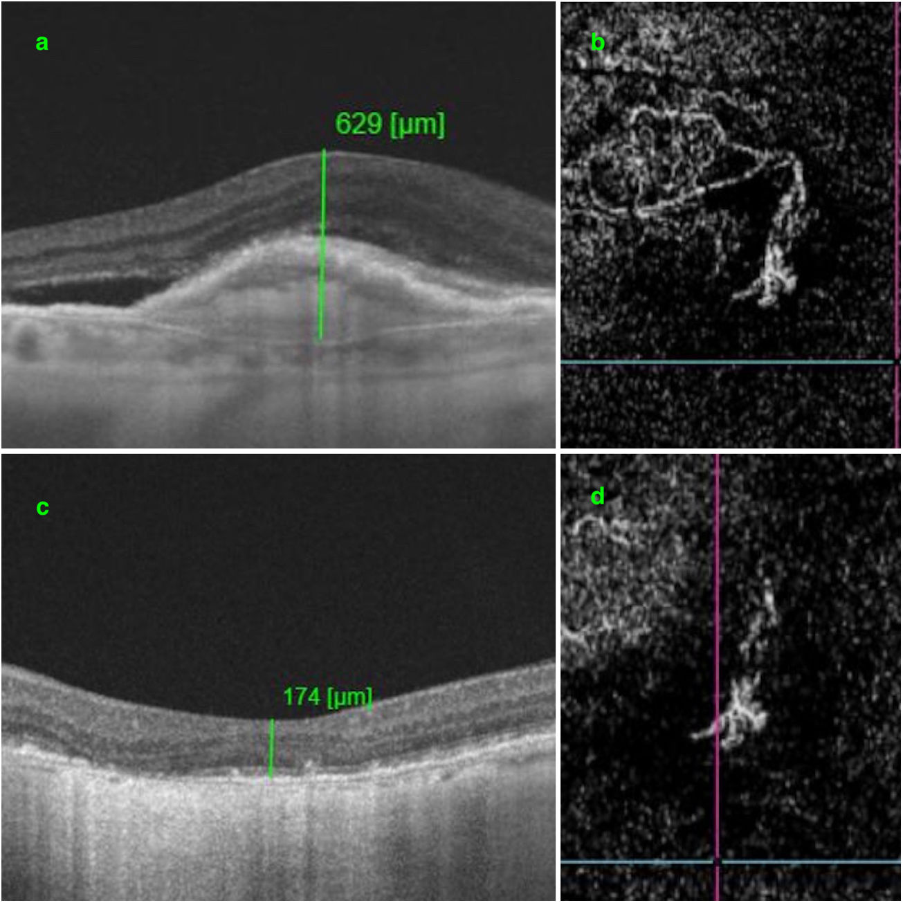 OCT angiography biomarkers in type 1 choroidal neovascularisation after ...