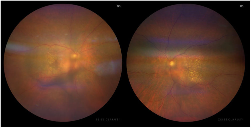 Autoimmune retinopathy with onconeuronal antibodies: Case report ...