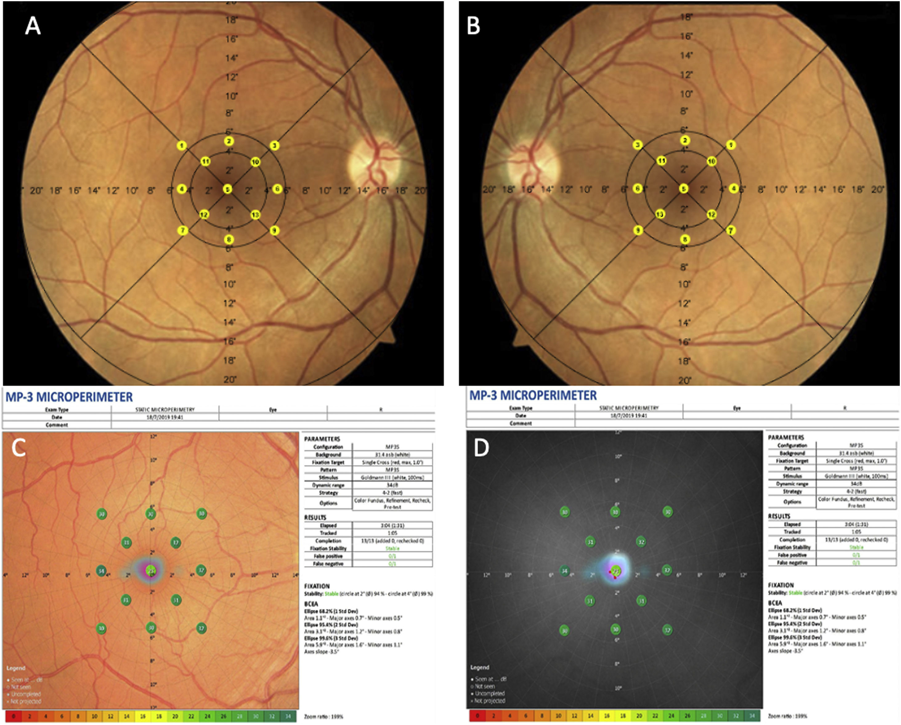 Fotopic and scotopic retinal sensitivity and foveal fixation normal ...