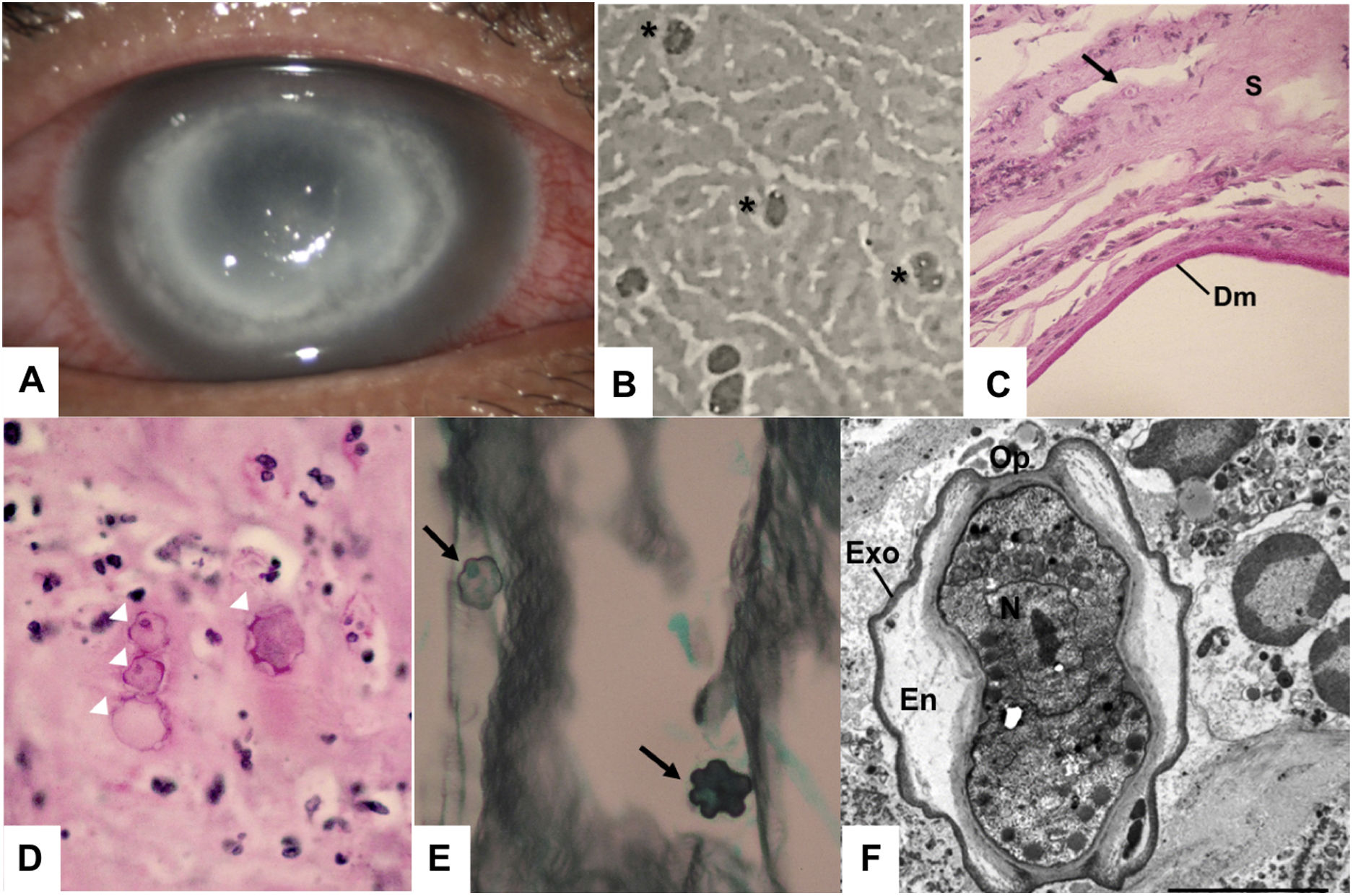 Microscopic features of an Acanthamoeba polyphaga keratitis | Archivos ...