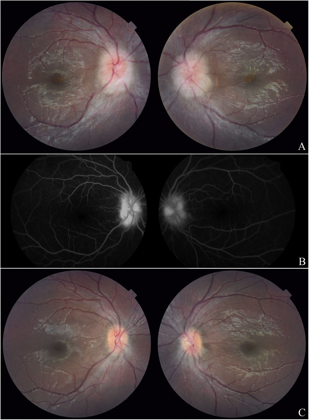 Bilateral neuroretinitis and membranous lupus nephritis: 2 infrequent ...