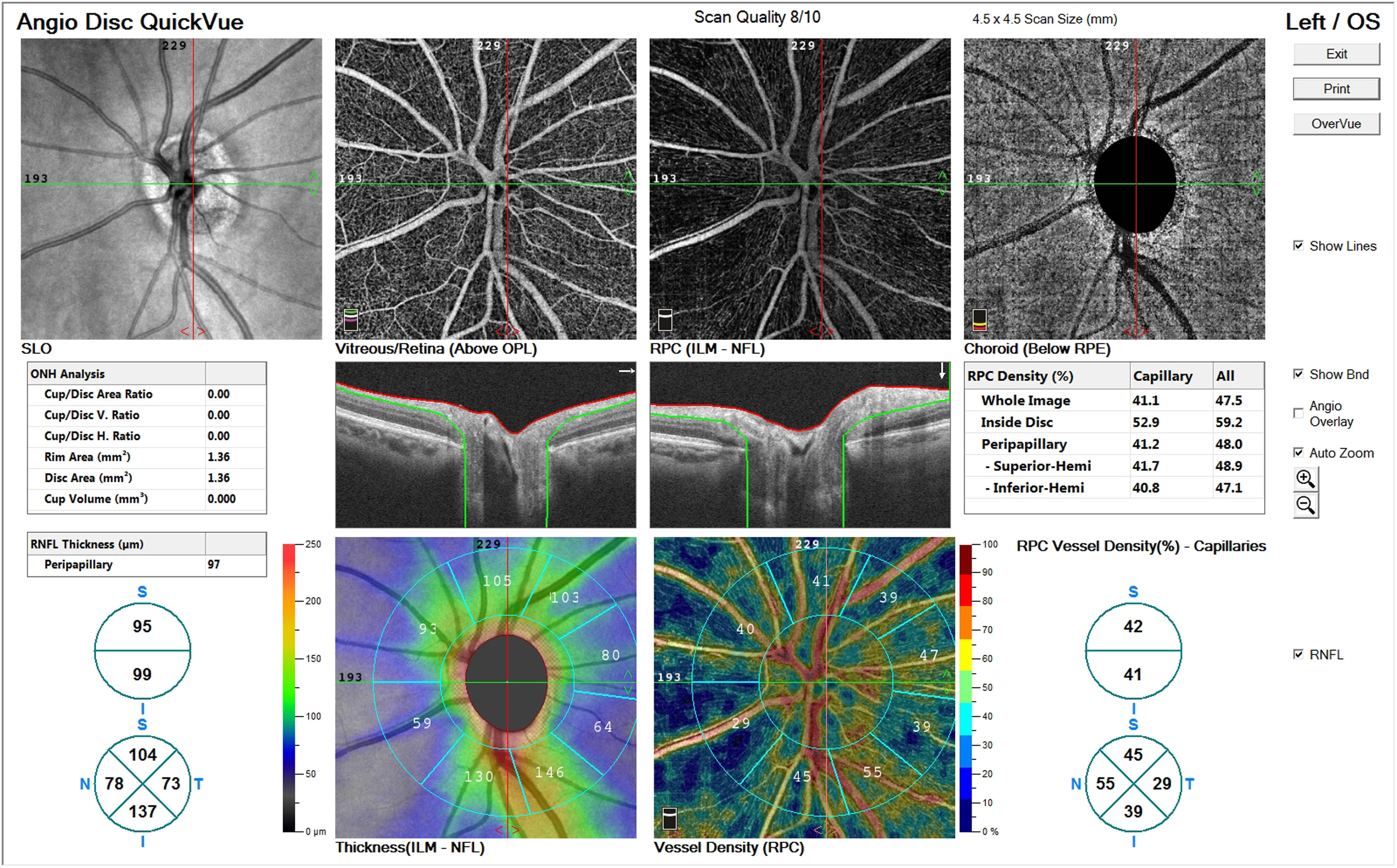 The effect of acetazolamide on the retinal and choroidal vasculature of ...