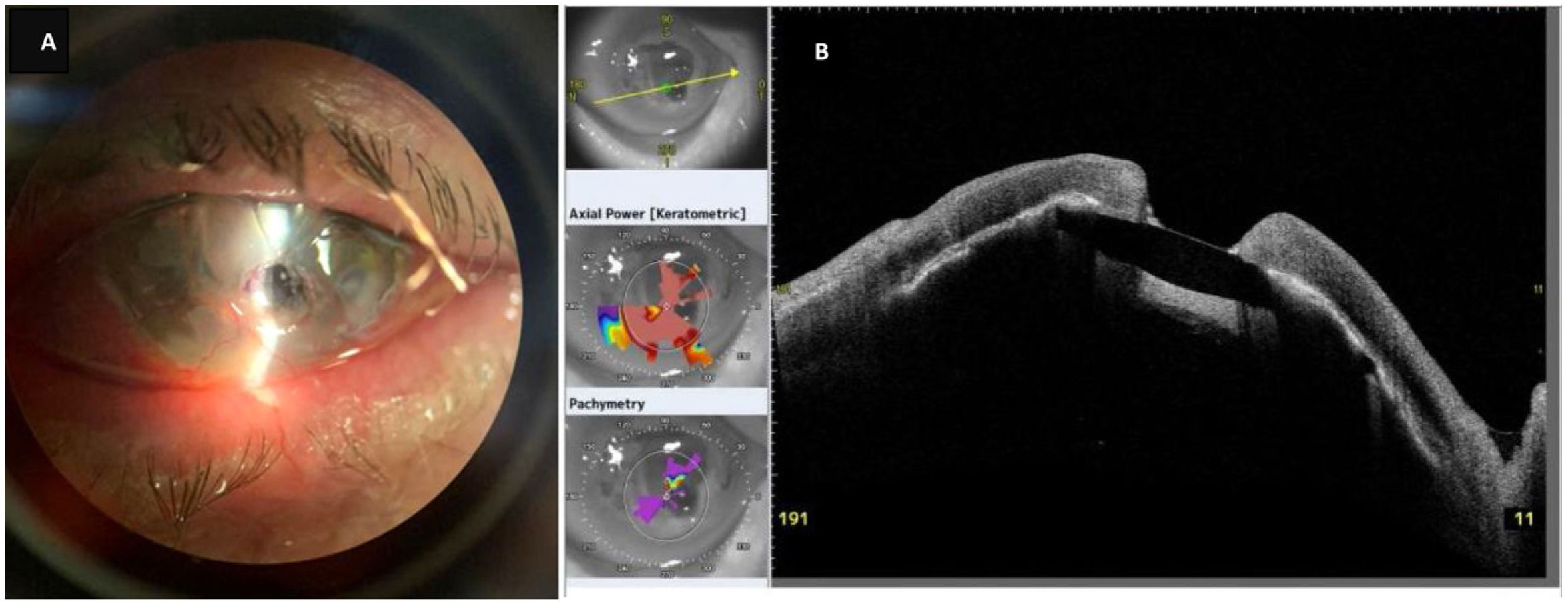 Perforation or not? Anterior segment optical coherence tomography as a ...