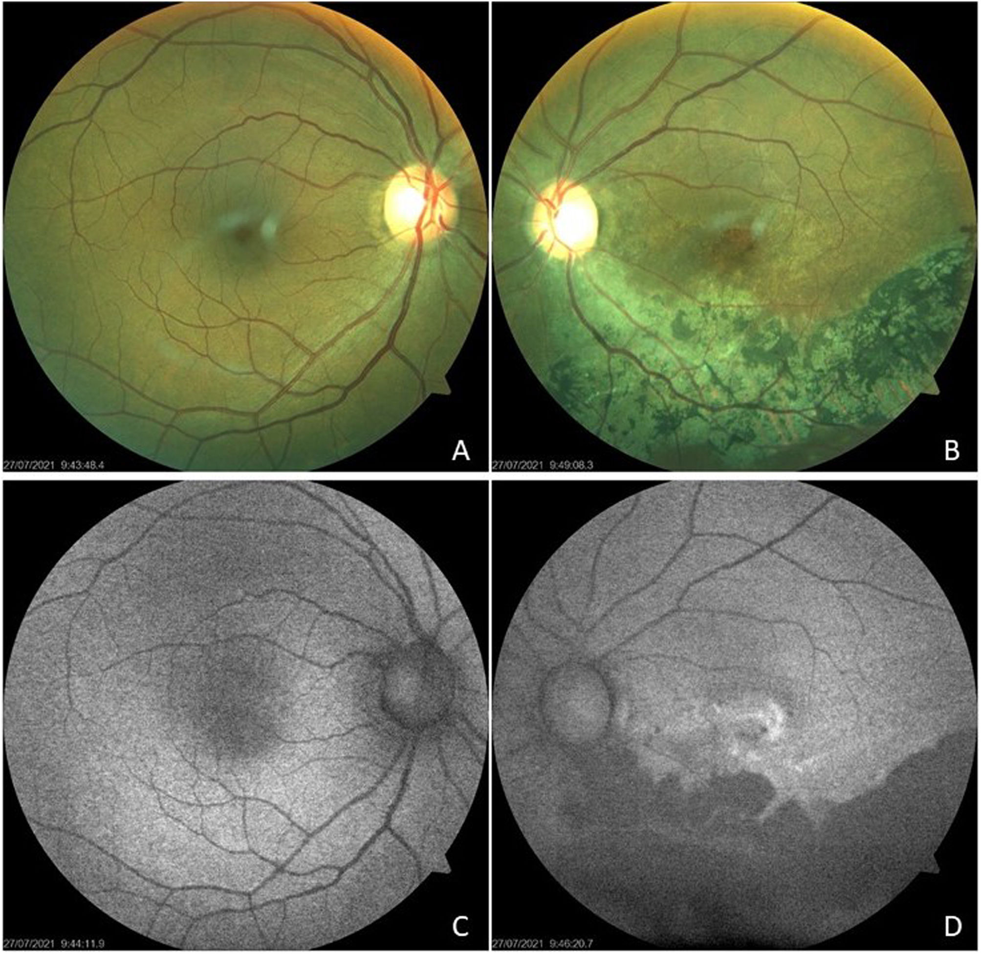 Unifocal and unilateral pigmented paravenous retinochoroidal atrophy ...