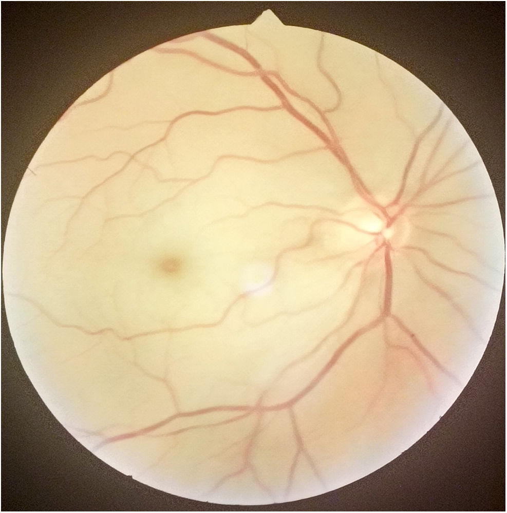 Central retinal artery occlusion following facial injection of ...