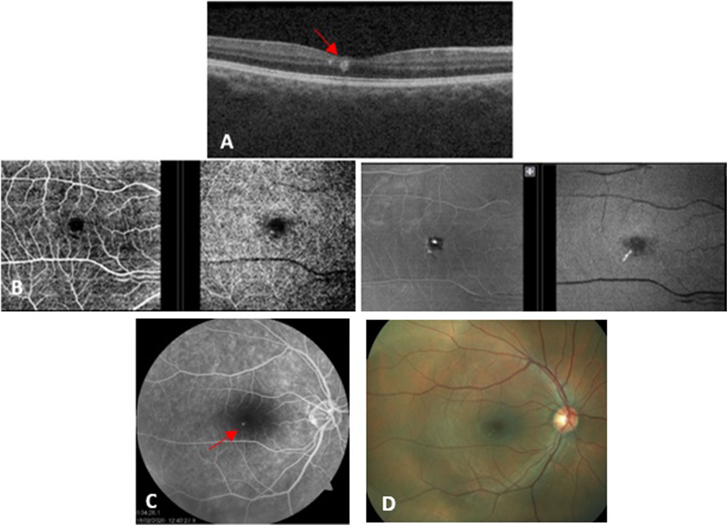 Perifoveal exudative vascular anomalous complex (PEVAC) | Archivos de ...