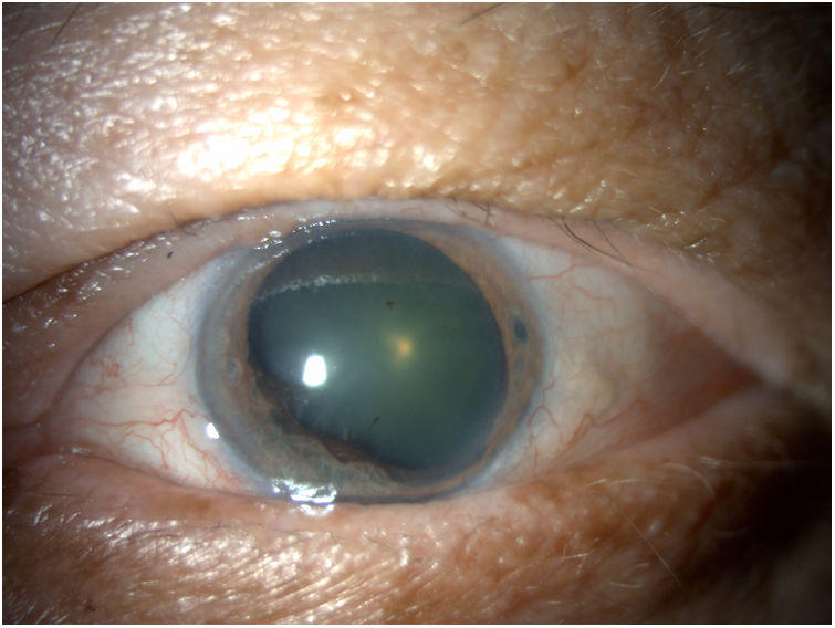 Neovascular glaucoma caused by small-cell lung cancer iris metastasis ...