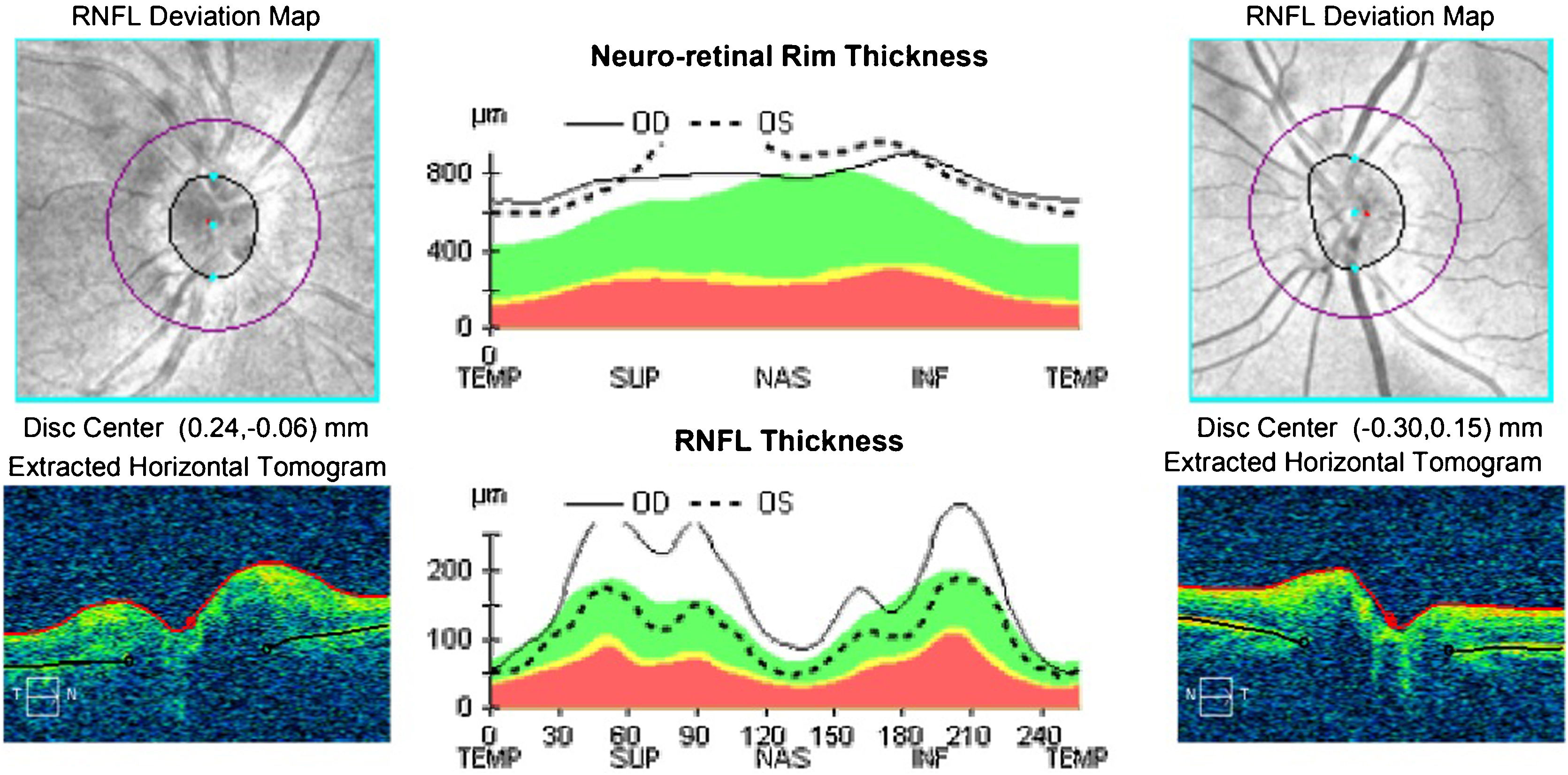 AZOOR with unilateral disc edema: An atypical case report | Archivos de ...