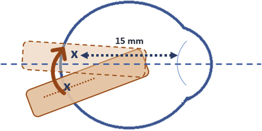 Supraequatorial displacement with lateral rectus myopexy for treatment ...