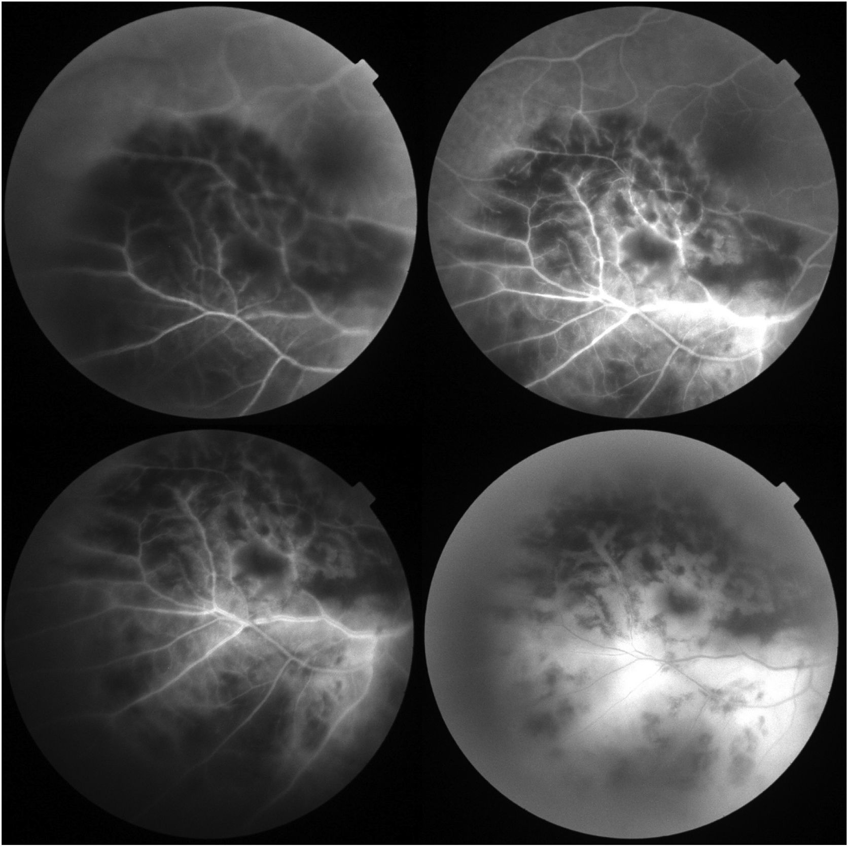 Subretinal abscess due to nocardia in an immunosuppressed patient: a ...