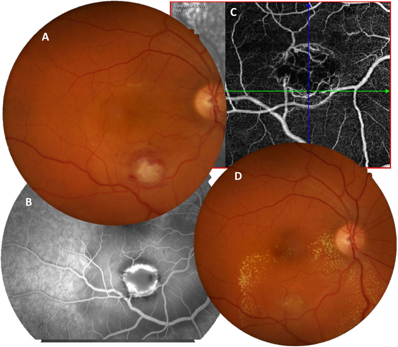 Multimodal imaging of a macular retinal capillary hemangioma | Archivos ...