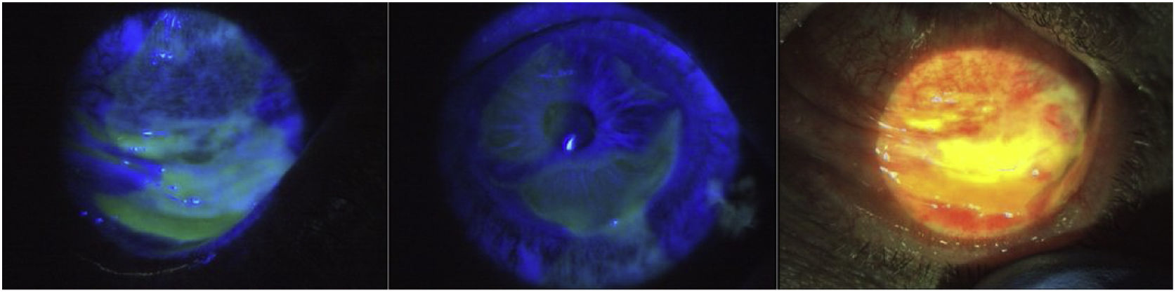 Ocular involvement secondary to Monkeypox virus infection | Archivos de ...