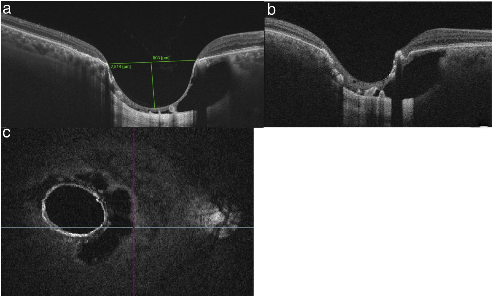 Choroid cavitation associated with macular coloboma. Multimodal study ...