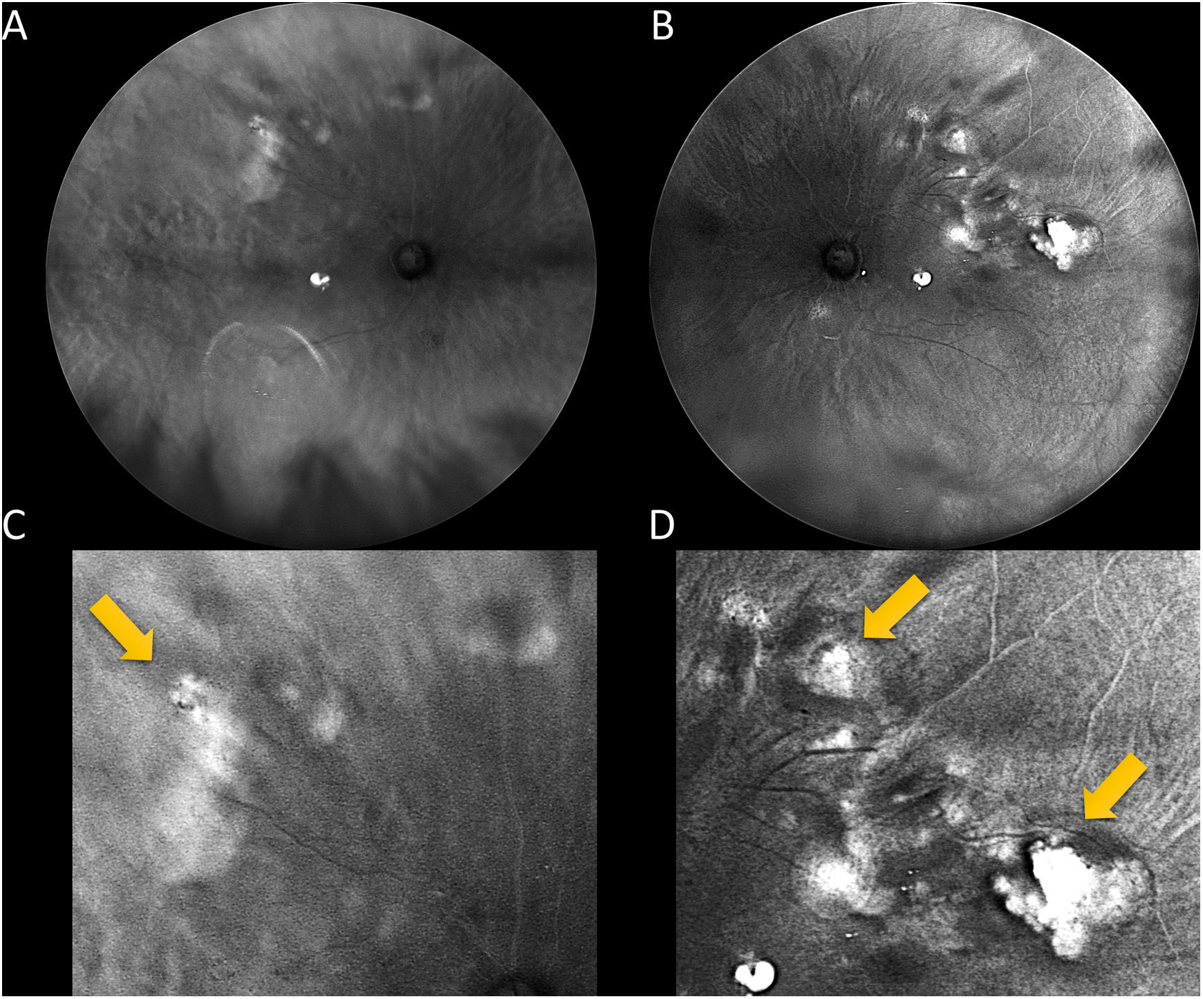 Multimodal and retro-mode imaging in sclerochoroidal calcification: A ...