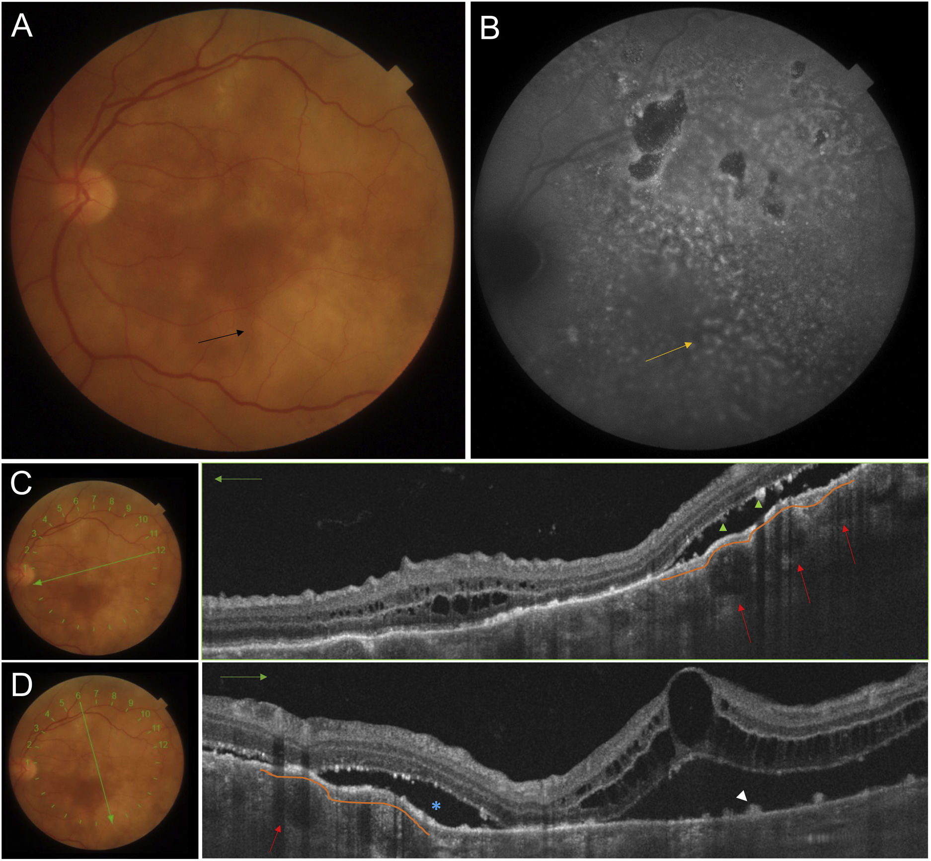 Multimodal study of diffuse choroid metastasis | Archivos de la ...