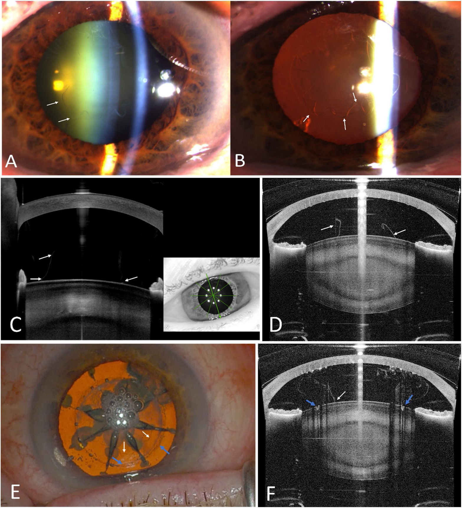 Femtosecond laser-assisted phacoemulsification in true exfoliation ...