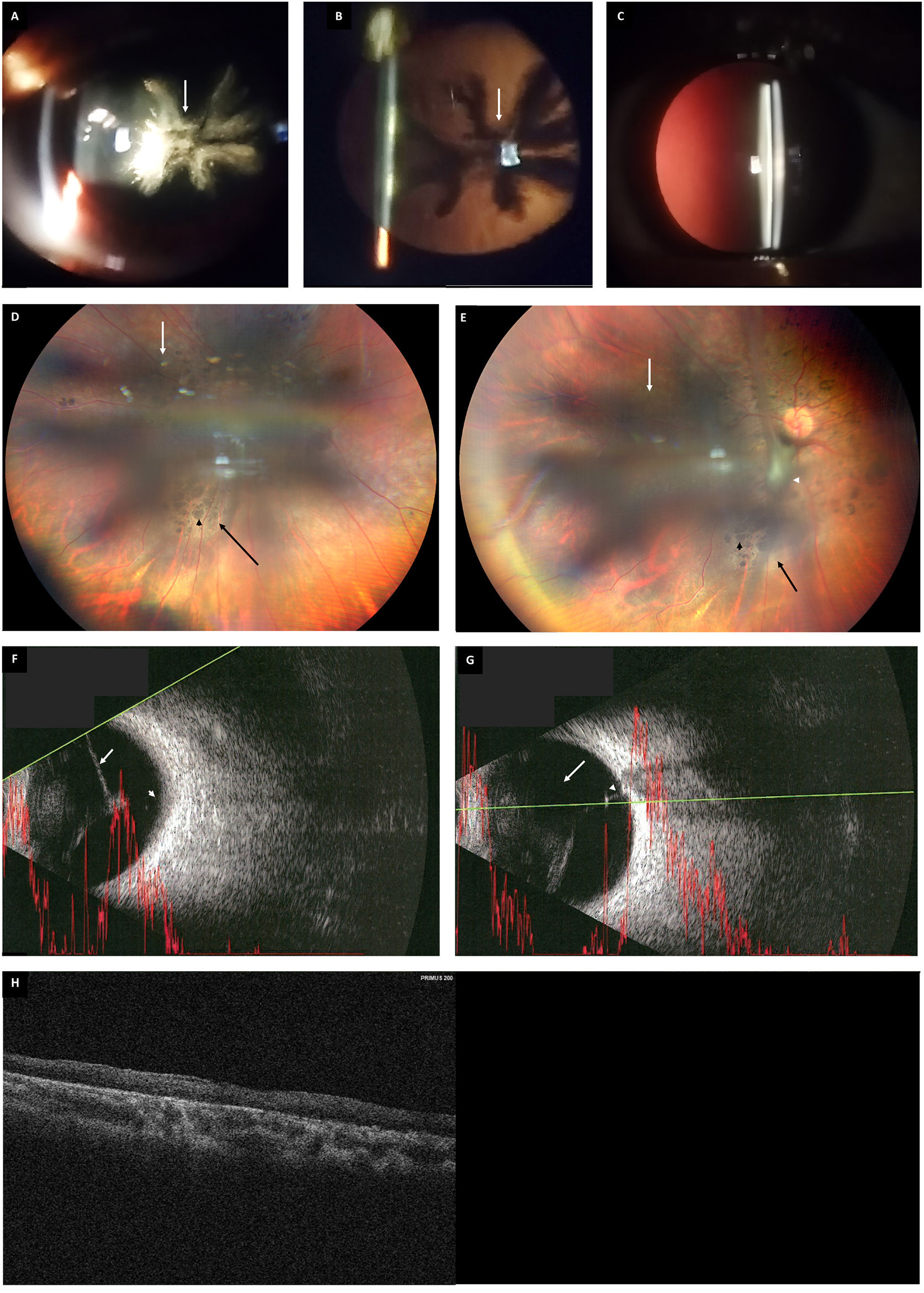 Untreated combined persistent fetal vasculature with “coralliform ...