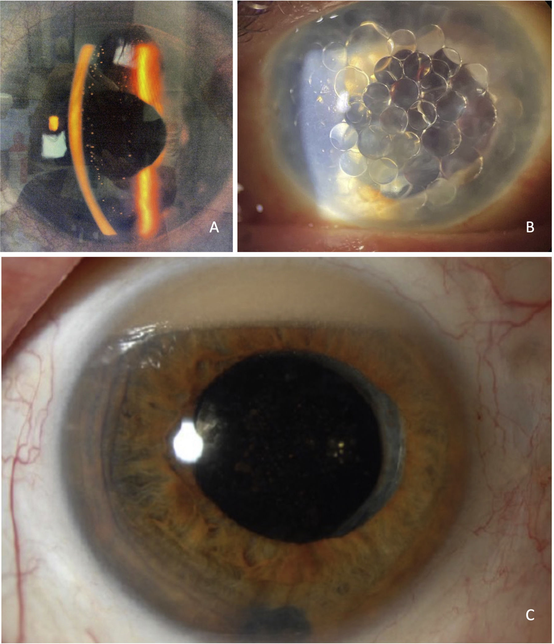 Emulsified silicone oil in anterior chamber | Archivos de la Sociedad ...