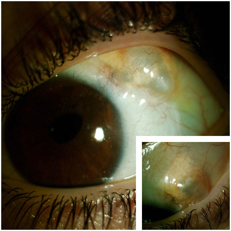 Epithelial inclusion cyst secondary to glaucoma surgery: A case series ...