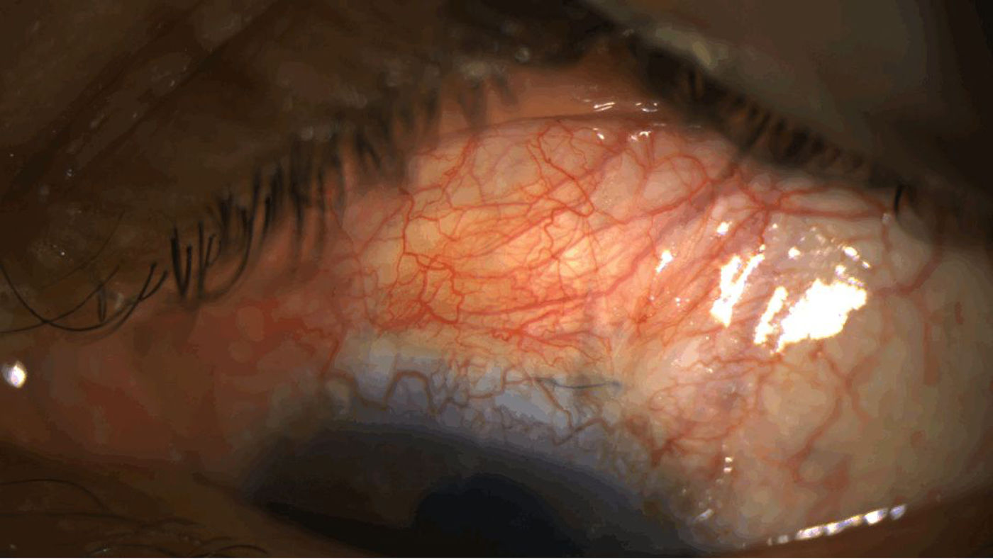 Suture dehiscence in patients with connective tissue disease: Marfan ...