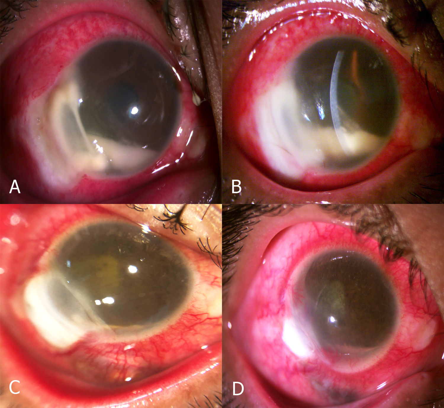 Pseudomonas-induced scleritis mimicking autoimmune necrotizing ...