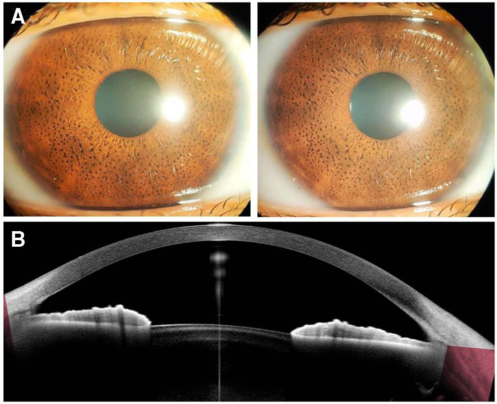 Bilateral iris mammillations. Anterior segment optical coherence ...