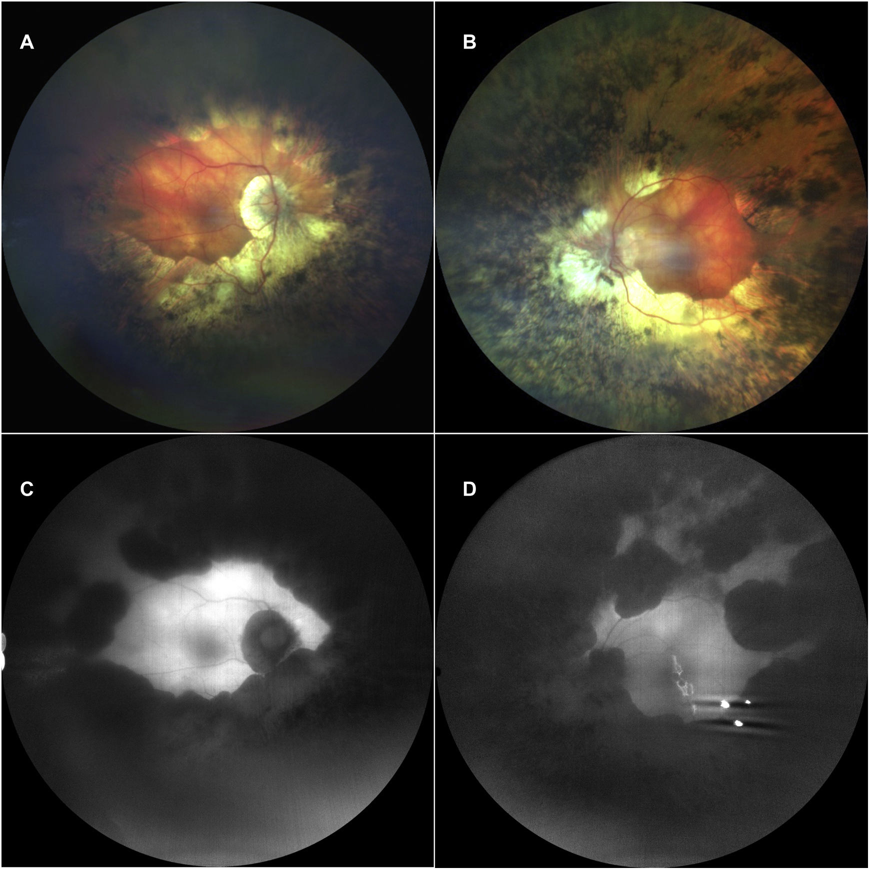 Gyrate atrophy of the choroid and retina: Update on diagnosis and ...