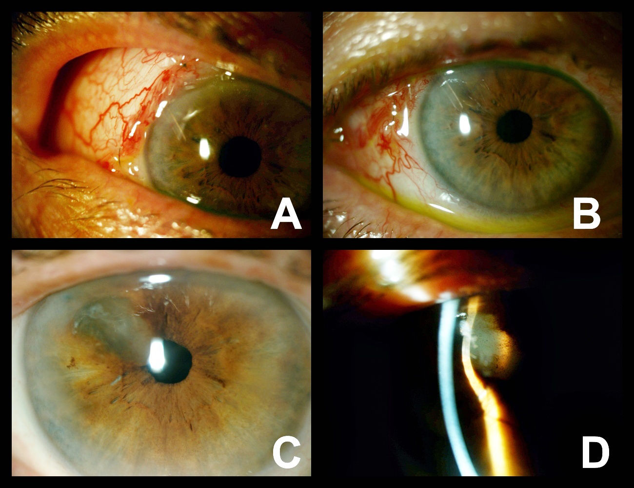 Epithelial inclusion cyst secondary to glaucoma surgery: A case series ...