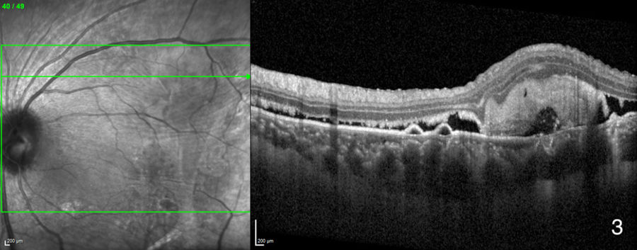 Fibrinous bullous central serous chorioretinopathy with exudative ...
