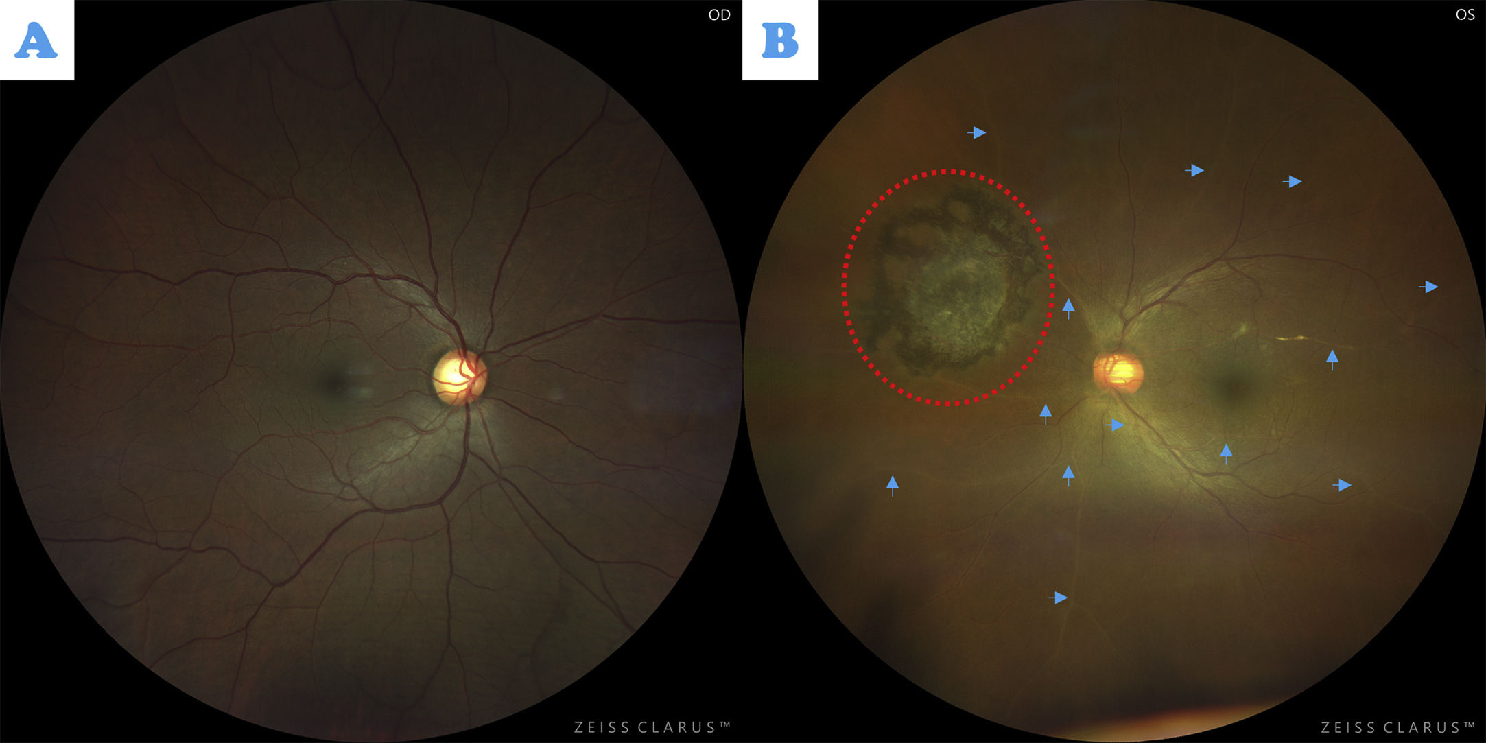 Post-traumatic retinal siderosis, a case report | Archivos de la ...