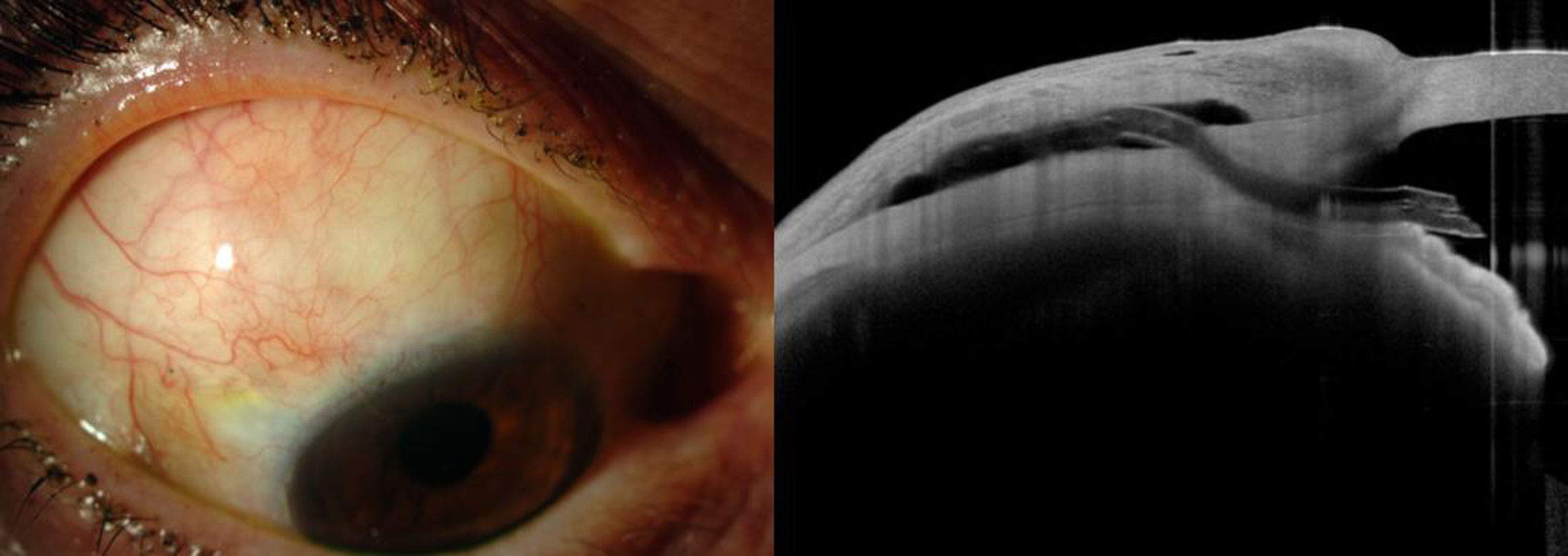 Anterior segment optic coherence tomography (OCT-SA) findings in ...