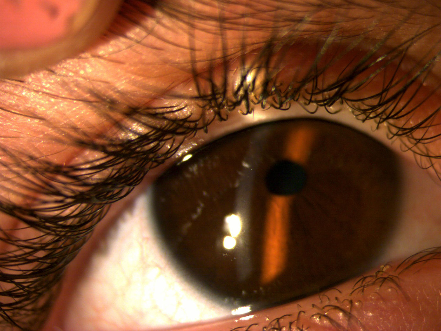 Microspherophakia associated with congenital miosis: Coincidence or ...