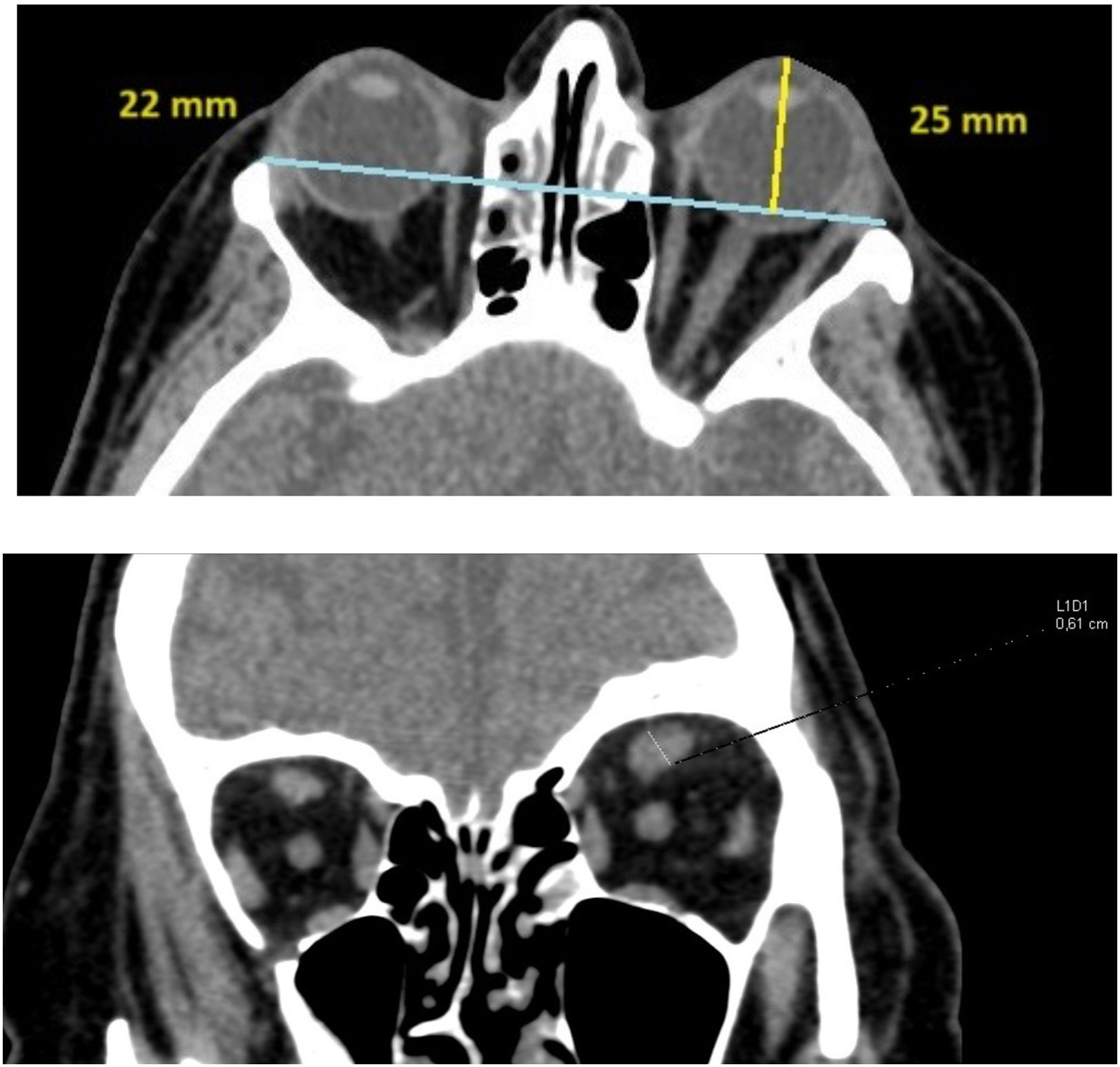 Intraorbital rituximab to treat orbital inflammation in a patient with ...