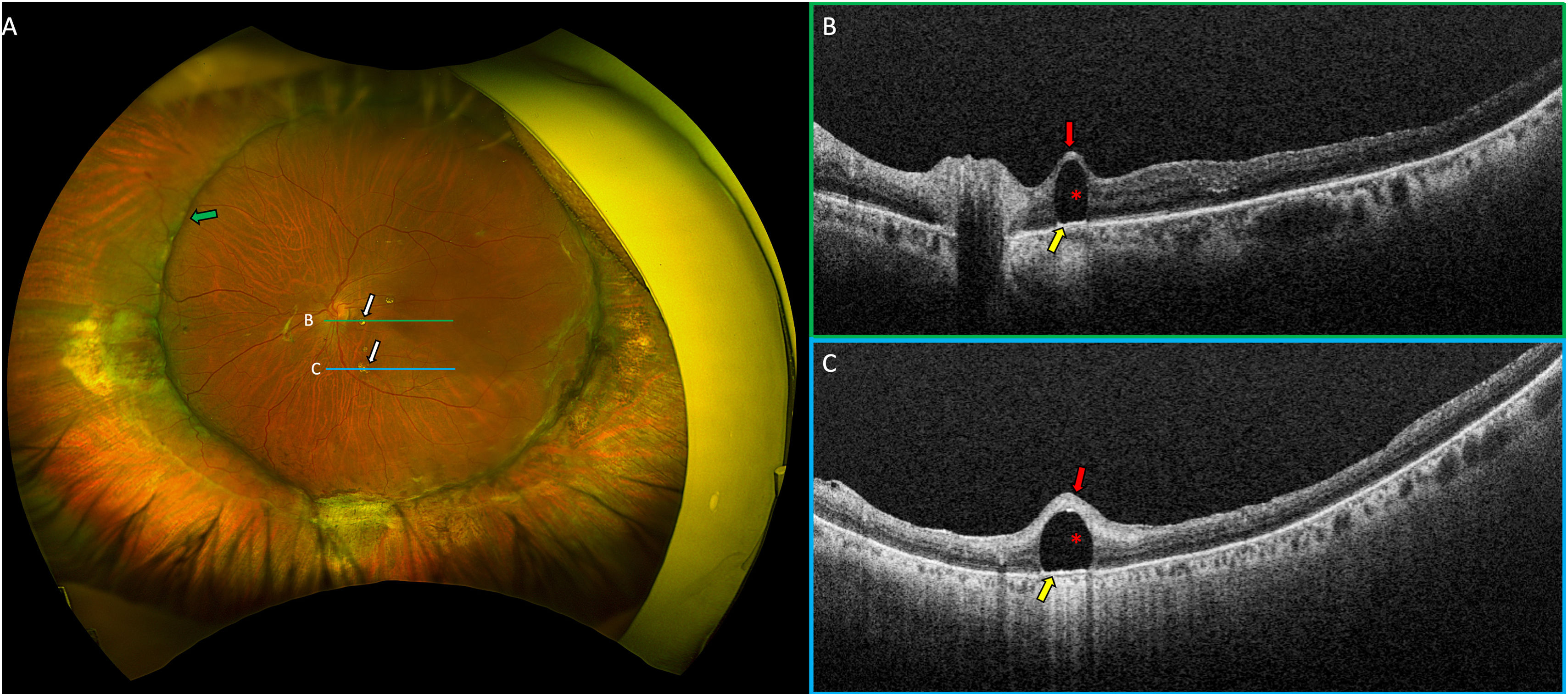 Multimodal imaging to detect retinal migration of perfluorocarbon ...
